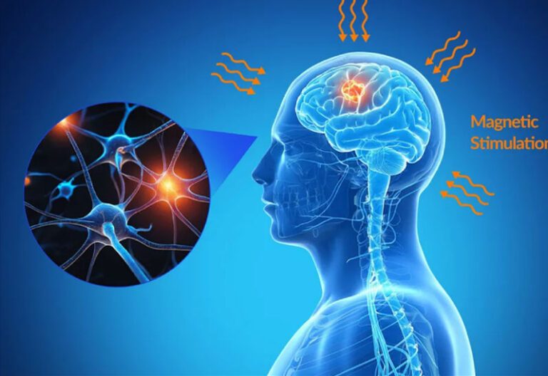 About us - TMS Therapy
